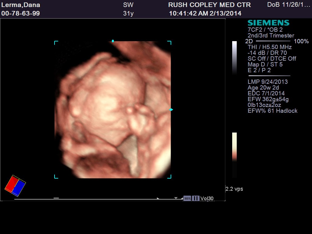 Little Lermas!: 20 Week Anatomy Scan