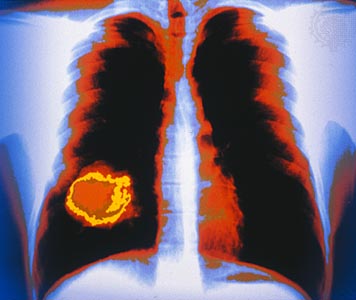 Lung Cancer: Lung Cancer Causes – Radon Gas
