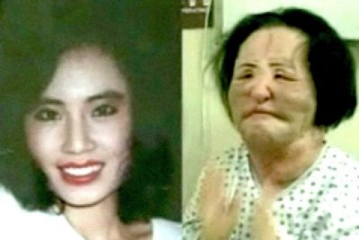 Hang Mioku, Plastic Surgery Addict Injects Cooking Oil Into Her Face ...