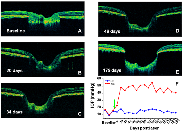 So What Exactly Is Glaucoma? | Carillon VisionCare - Glenview, IL