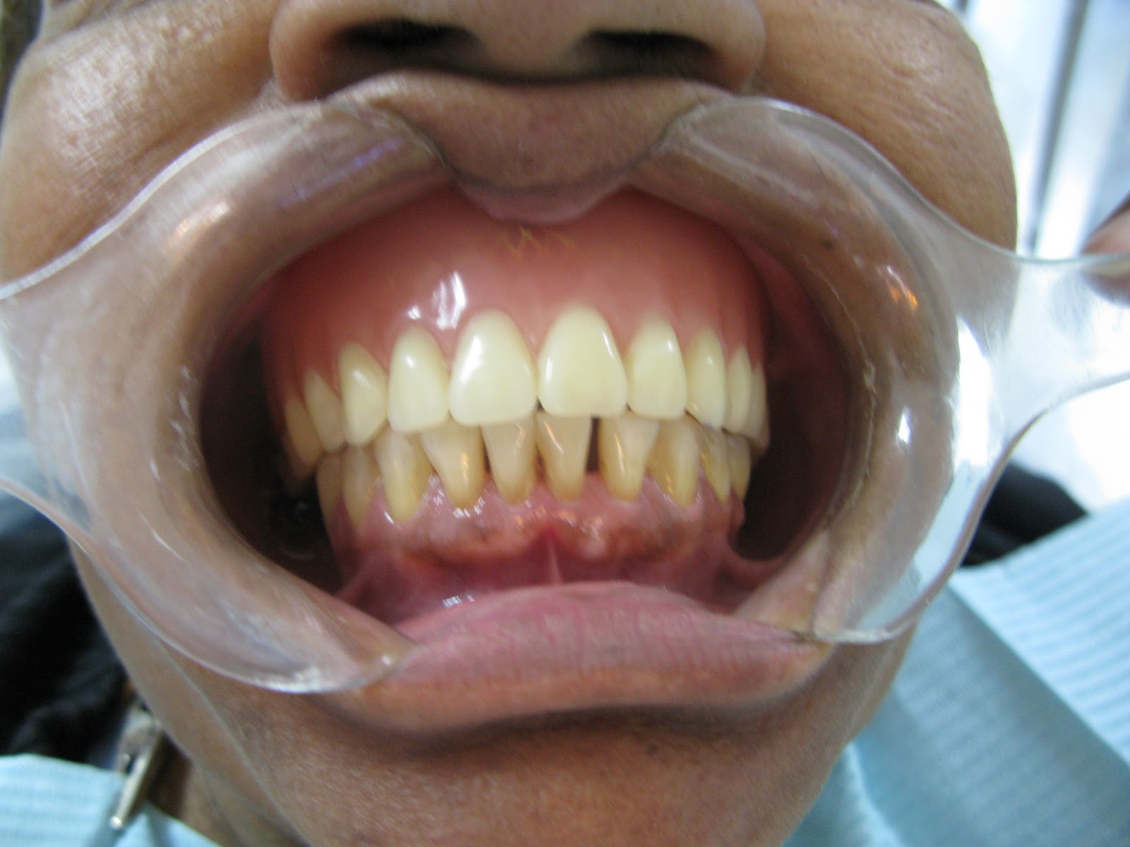 Caso 2 Clinica III Protesis total superior vs. PPR Cromo cobalto inferior