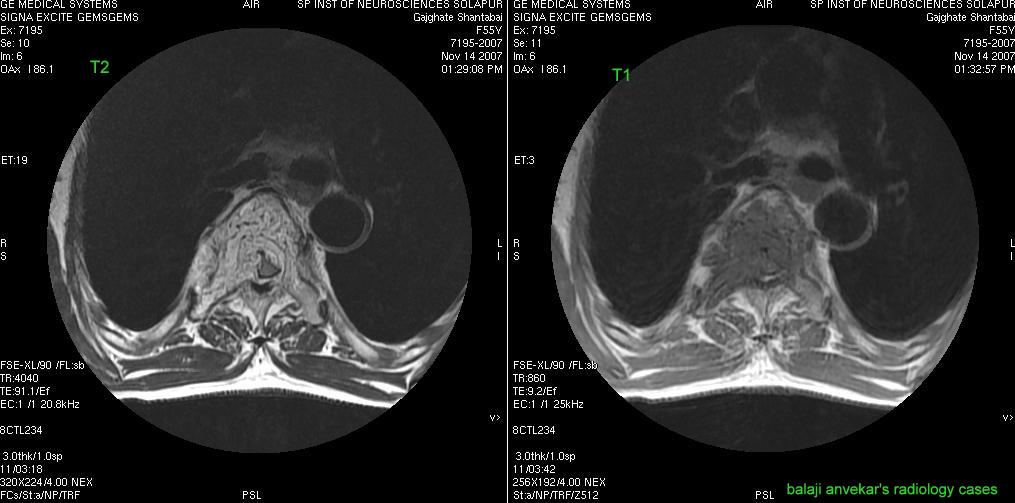 Dr Balaji Anvekars Neuroradiology Cases Aggressive Hemangioma Mri Spine