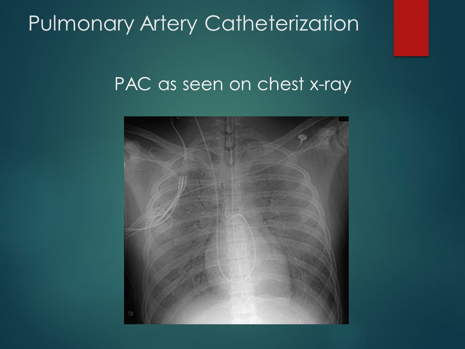CVT Mohd Farid: Introduction To Right Heart Catheterization
