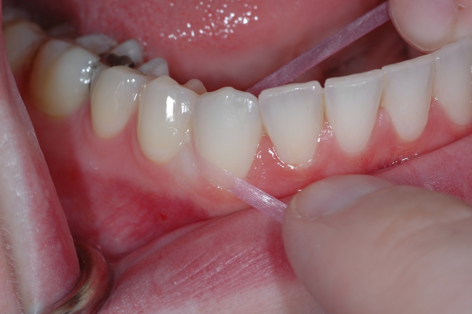 The Buzz from Your Favorite Dental Hygienists: June 2011