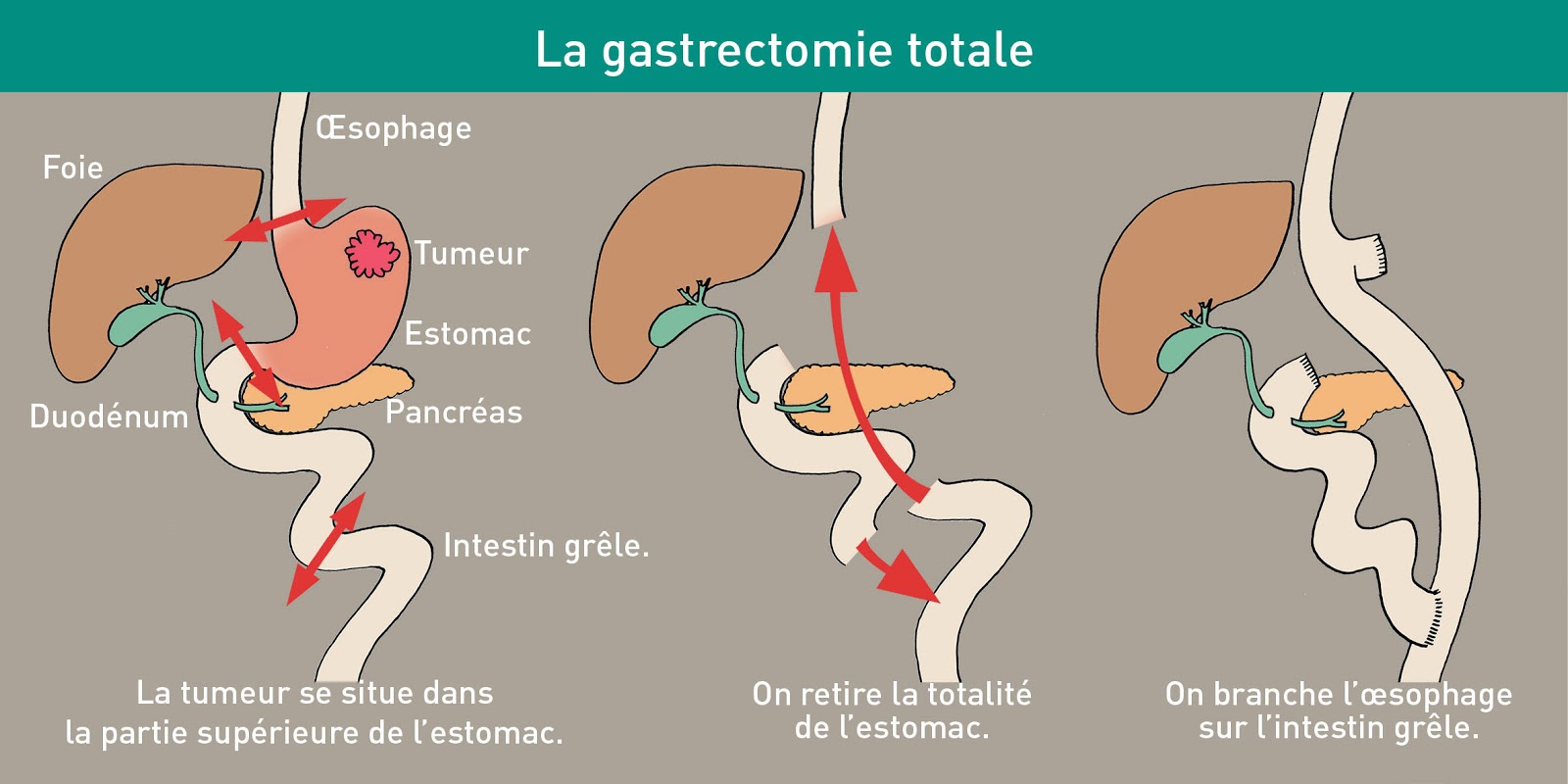 CHIRURGIE DIGESTIVE ET HEPATO-BILIAIRE: Cancer de l'estomac