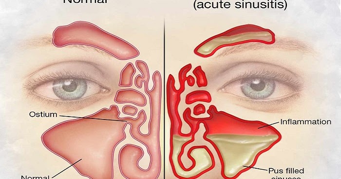 Houston Sinus Center | About ENT Problems: Common Reasons That Lead To Acute Sinusitis