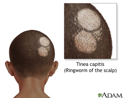 Tinea capitis ~ Enfermedades Médicas