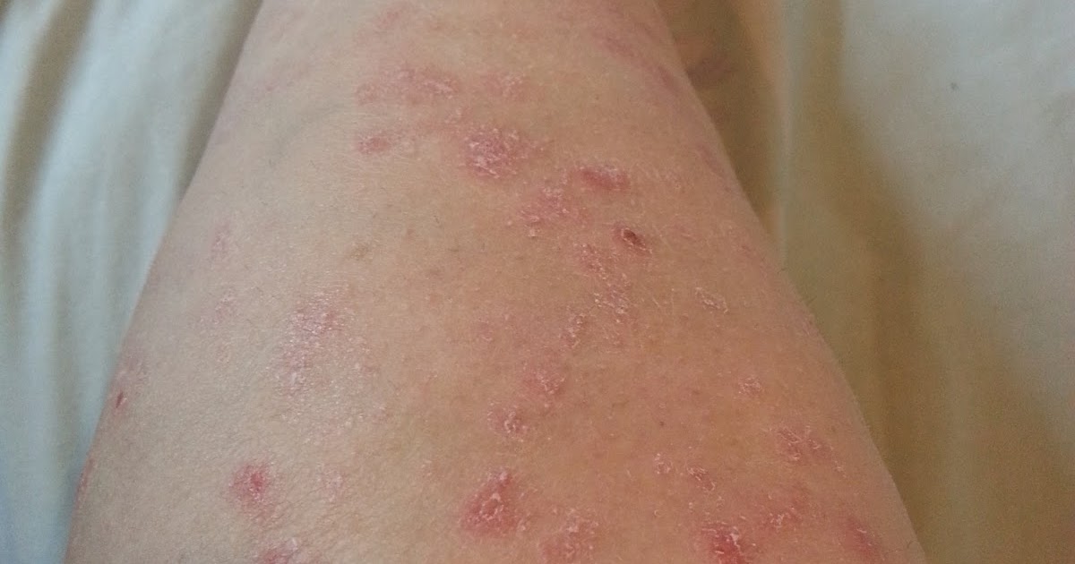 The Lights Are On, But No One's Homer!: Psoriasis flare up - May 2013