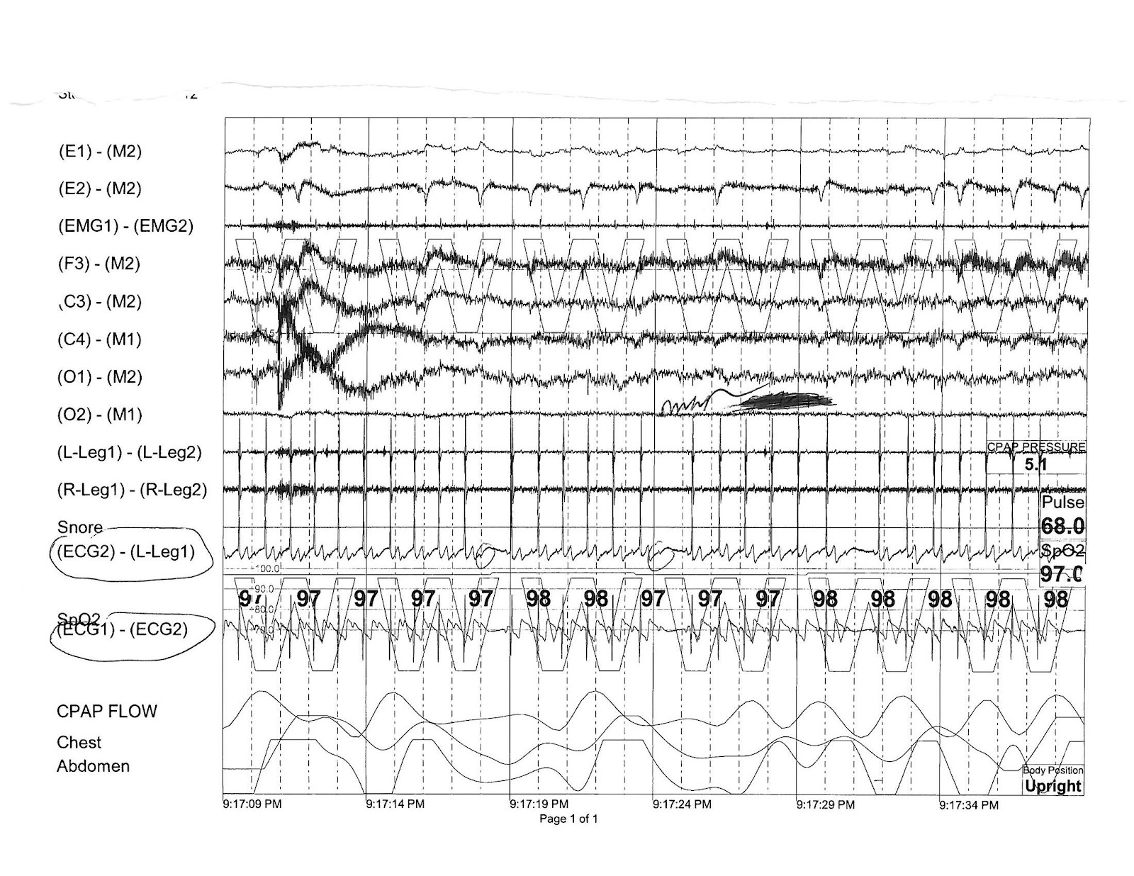 sleepdoctor: EKG During Sleep Study