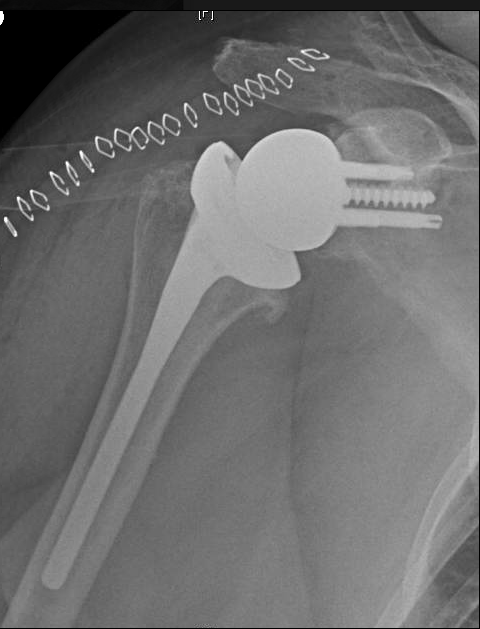 Shoulder Arthritis / Rotator Cuff Tears / Shoulder Pain : Nerve injury ...