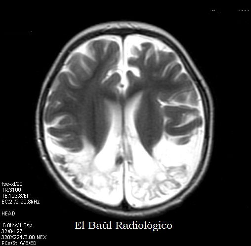 El Baúl Radiológico: ATROFIA DEL CUERPO CALLOSO: HALLAZGOS EN TC e IRM ...