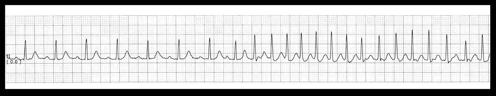 Various Supraventricular Tachycardias