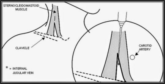 Procedures Club: The Blind Internal Jugular Central Catheter