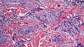 Microscope World Blog: Cellular Neurothekeoma under the Microscope