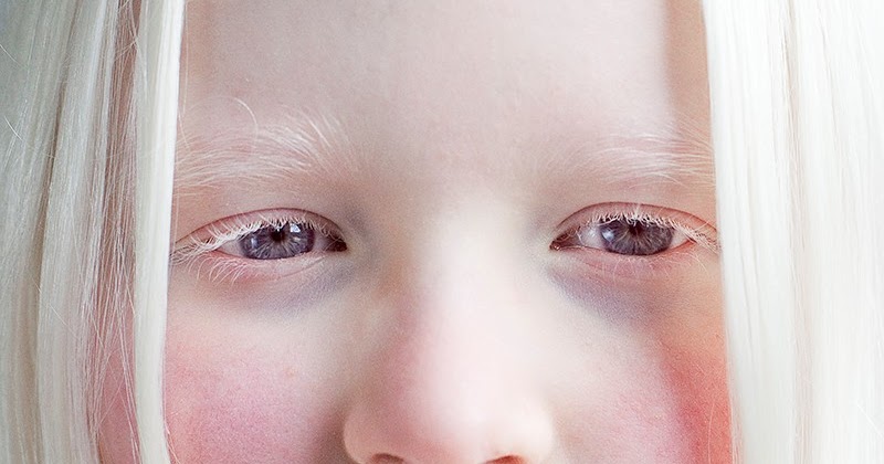 ALBINOs & THE TROUBLES THEY FACE.... - HearSayGh