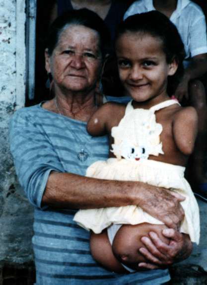 GEDR: SÍNDROME focomelia Schinzel