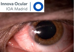 Miranza IOA: PTERIGION