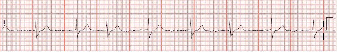 EKG Rhythm Strips 10