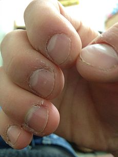To Your Health: QUICK TIPS ON HOW TO STOP BITING YOUR CUTICLES OR ...