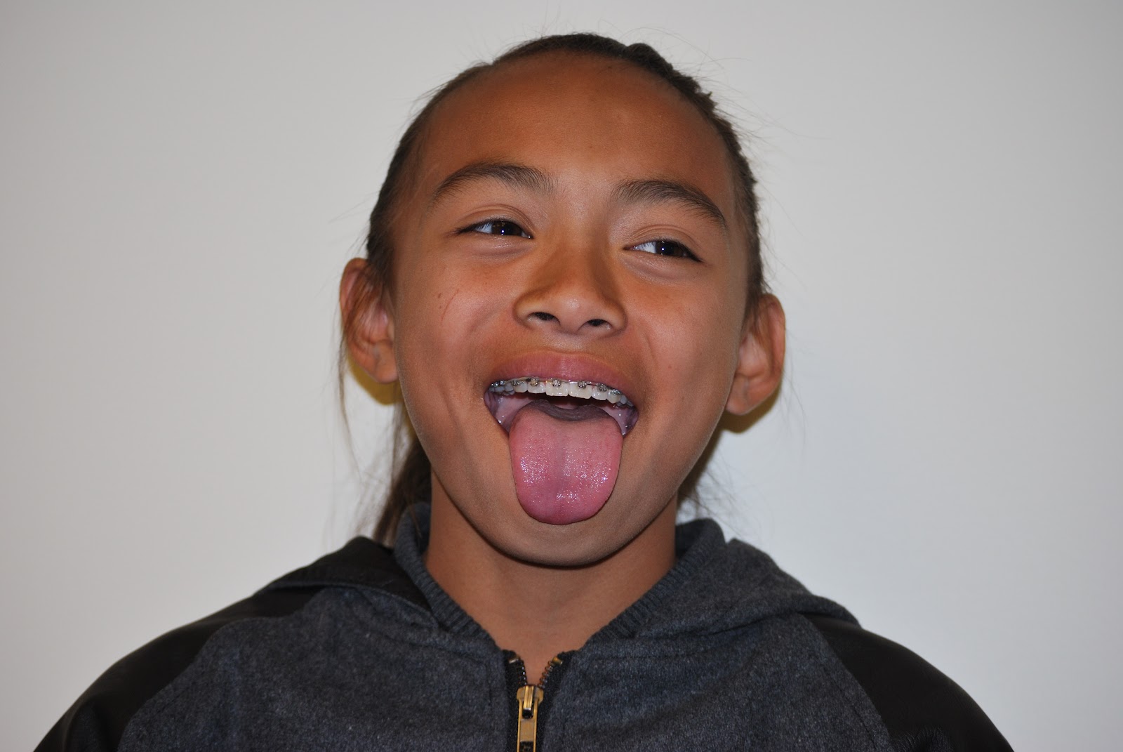 Myofunctional Therapy: OroFacial Muscle Re-Education