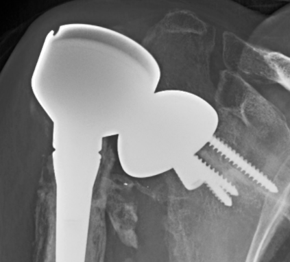 UW Shoulder and Elbow Academy: Reverse total shoulder - dislocations ...