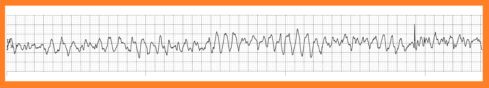EKG Rhythm Quiz 278: Ventricular Rhythms