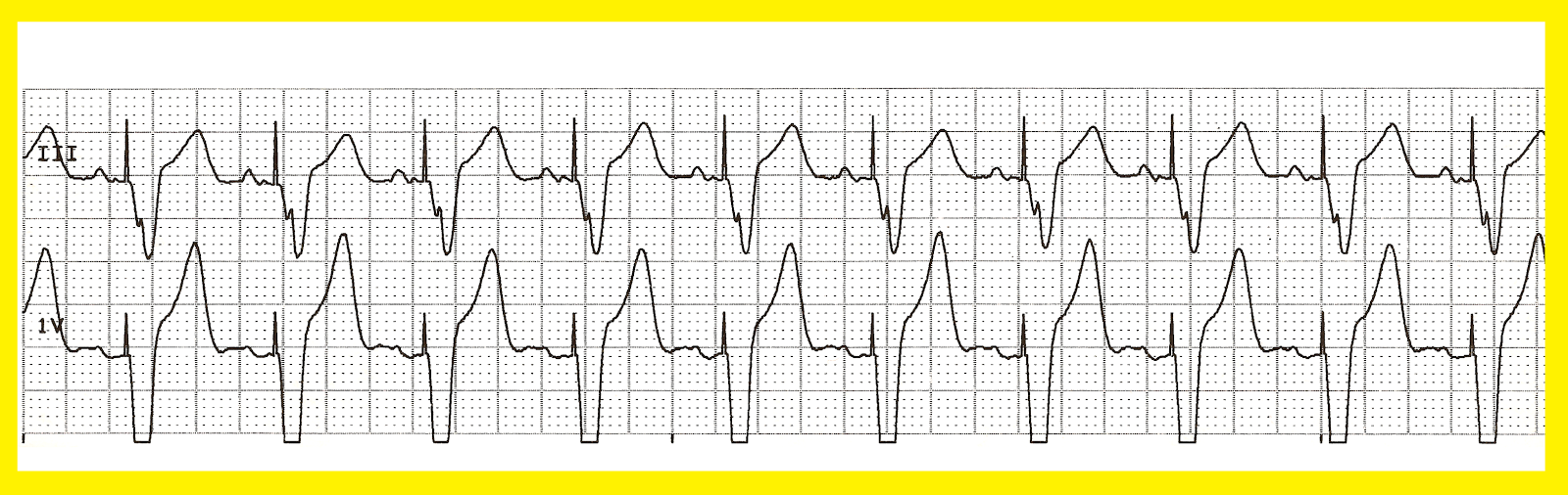 Various Ventricular Paced Rhythms