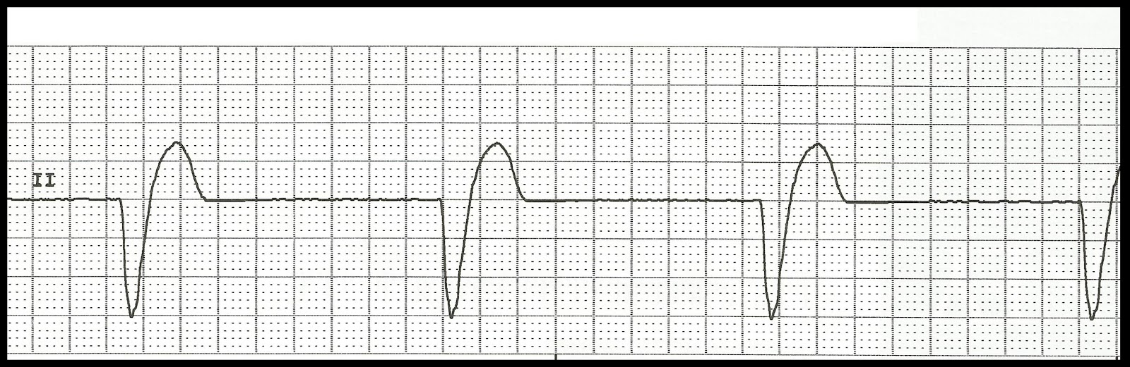 Basic ECG Rhythm Test 03