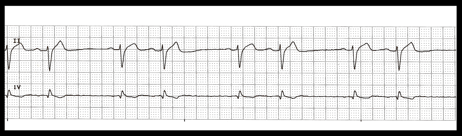 EKG Rhythm Quiz 226