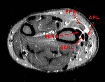 Extensor Pollicis Longus Mri