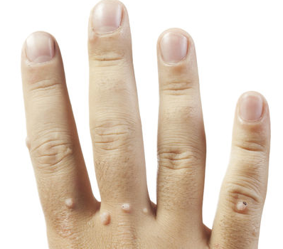 Citología Exfoliativa Mérida: VPH o Virus del Papiloma Humano