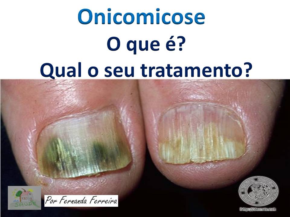 Casa da Saúde: Onicomicose? - O que é, como tratar?