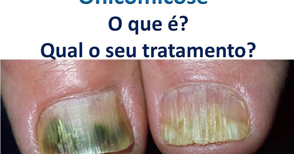Casa da Saúde: Onicomicose? - O que é, como tratar?