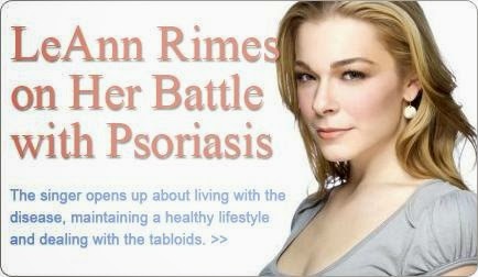 ROMANTIC AND CHIC: Descubre la Psoriasis y las famosas