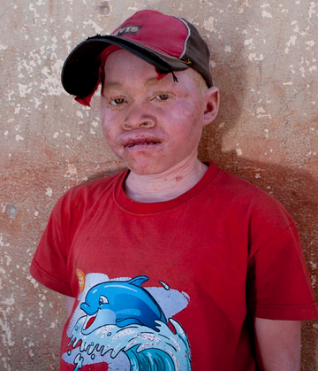 Angola Rising: Angolan Albinos: Living with Health and Social Challenges