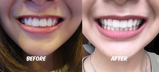EUNICE ANNABEL: After a Year of Invisalign! (Invisalign Review)