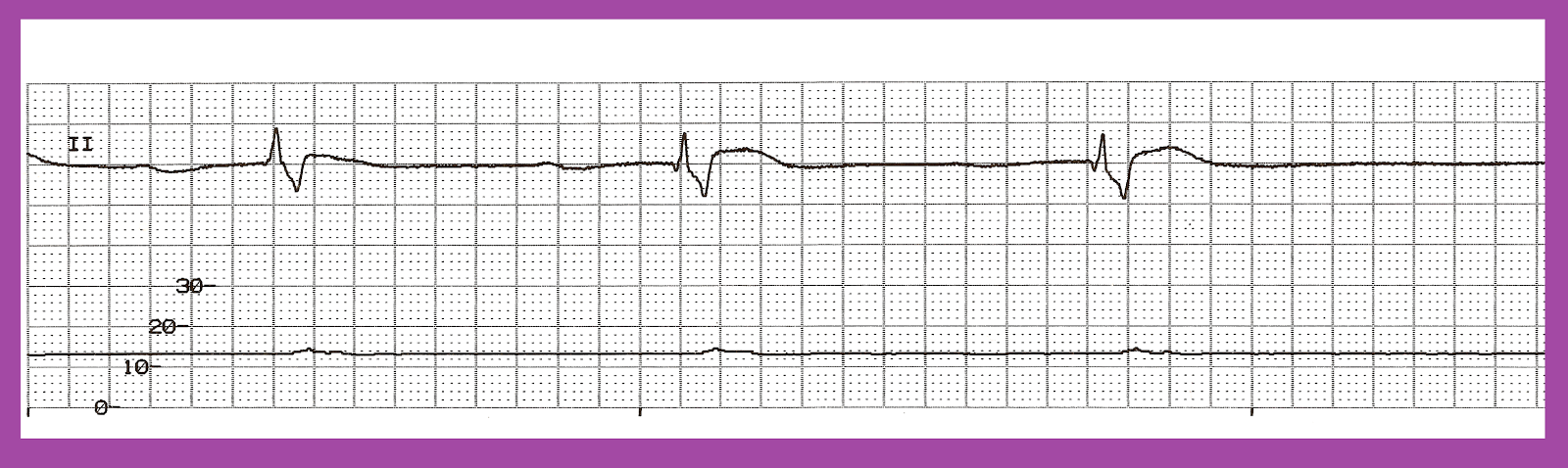 Various Idioventricular Rhythms