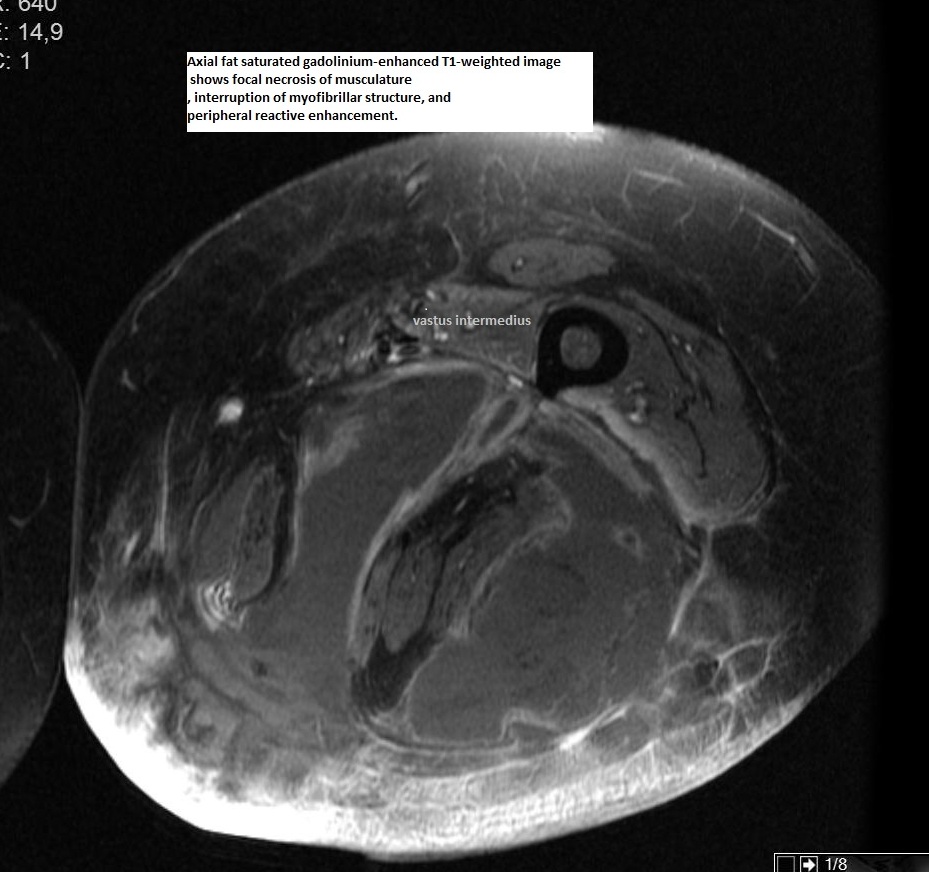 Diabetic myonecrosis-MRI - Sumer's Radiology Blog