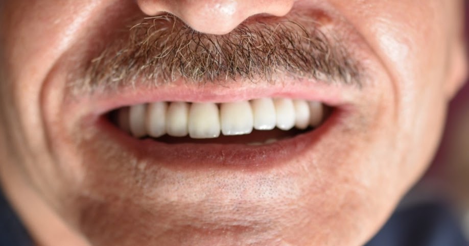 Odontología Especializada: Recupera todos tus Dientes con Implantes ...