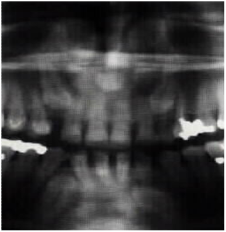 Dentistry and Medicine: Surgical management of Unerupted and Impacted teeth
