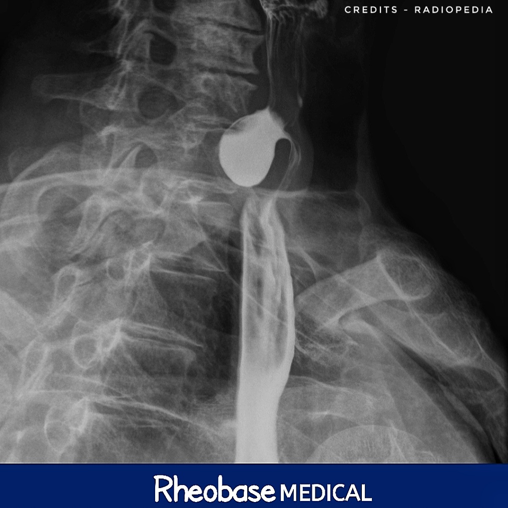 Rheobase Medical: Zenker's Diverticulum