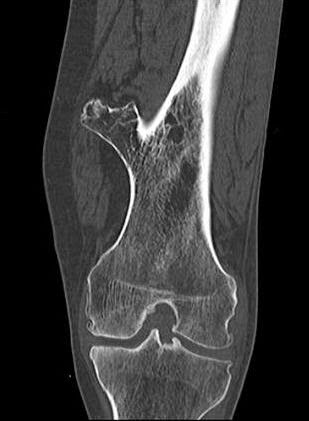 Diarios de Radiologia: Osteocondroma