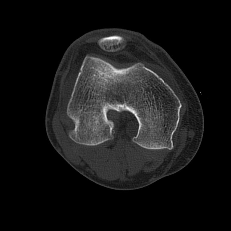 CT Knee - Radiology Imaging