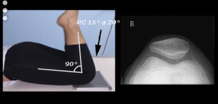 Joelho- Metodo de Settegast