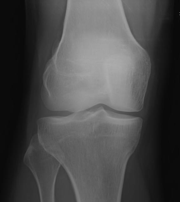 Reumails. Reumatología al día: Caso Clínico: Dolor de rodilla de larga ...