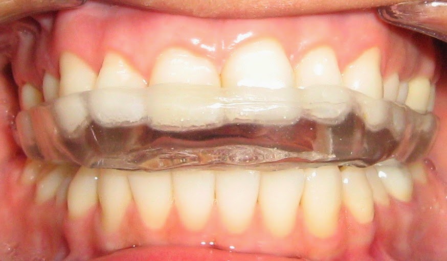 es: Disfunción Craneomandibular -ATM-