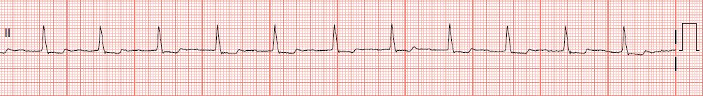EKG Rhythm Strips 28: Junctional Rhythms