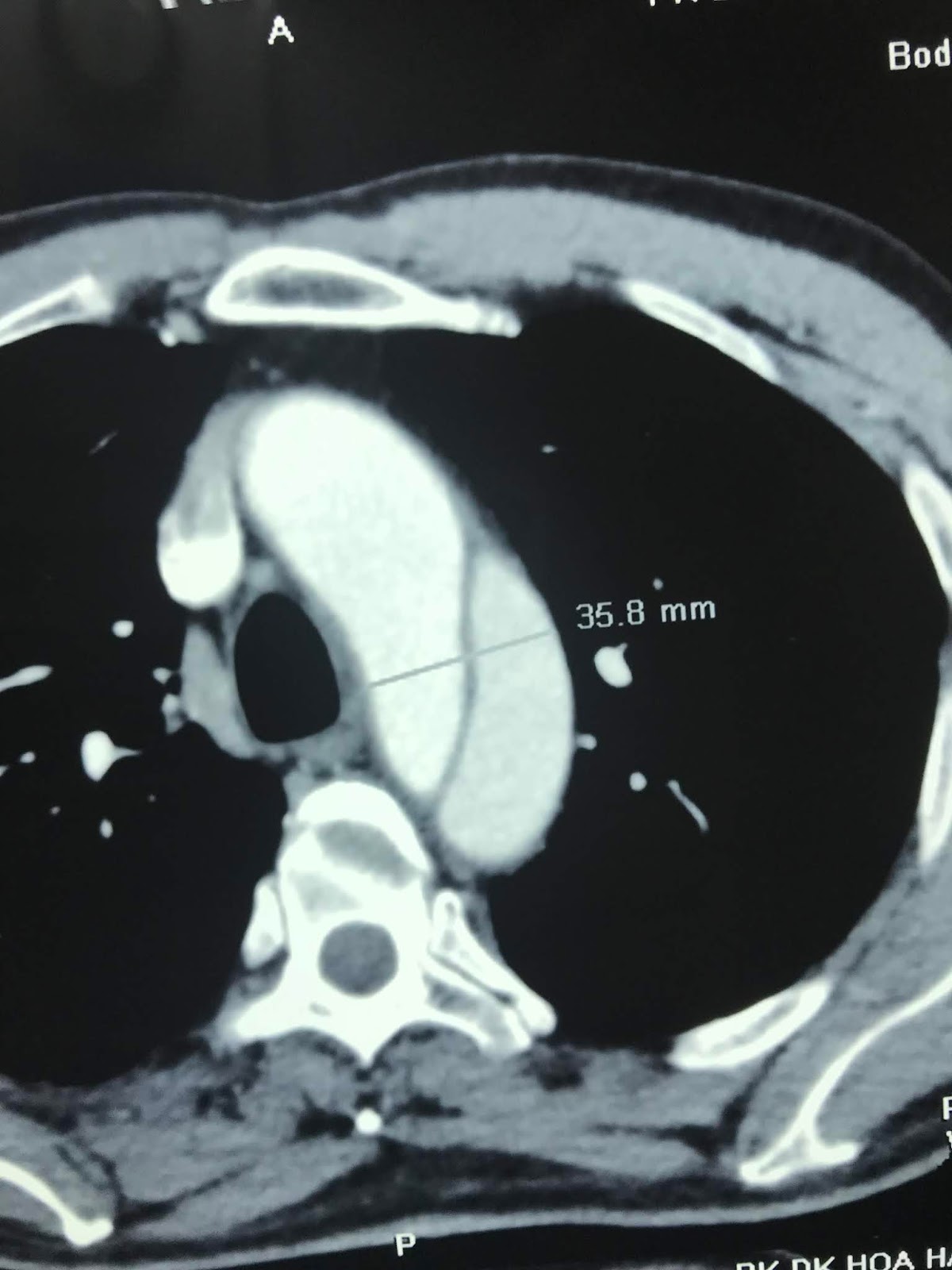 VIETNAMESE MEDIC ULTRASOUND: CASE 545: AORTIC DISSECTION, Dr PHAN THANH ...