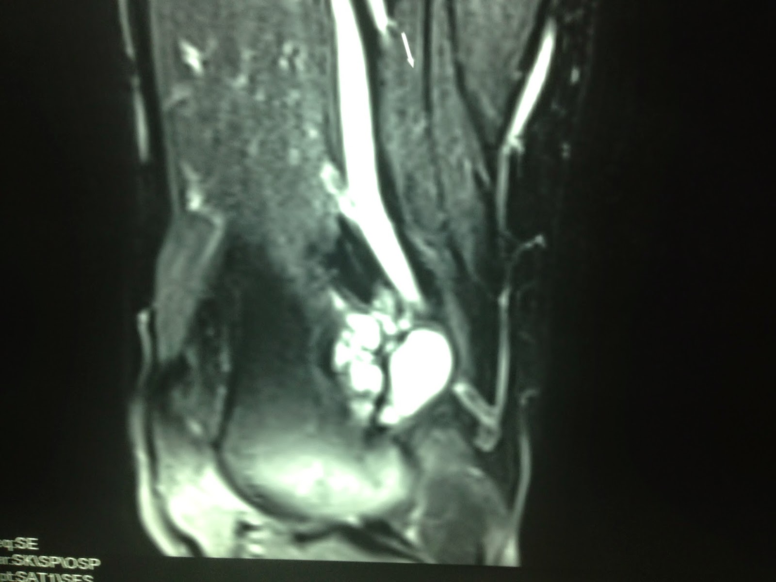 VIETNAMESE MEDIC ULTRASOUND: CASE 277: CLOSE BY KNEE JOINT TUMOR, Dr ...