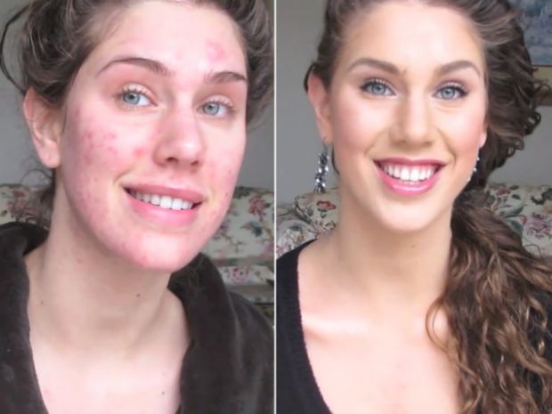 How to Cover Acnes With Makeup - Makeup